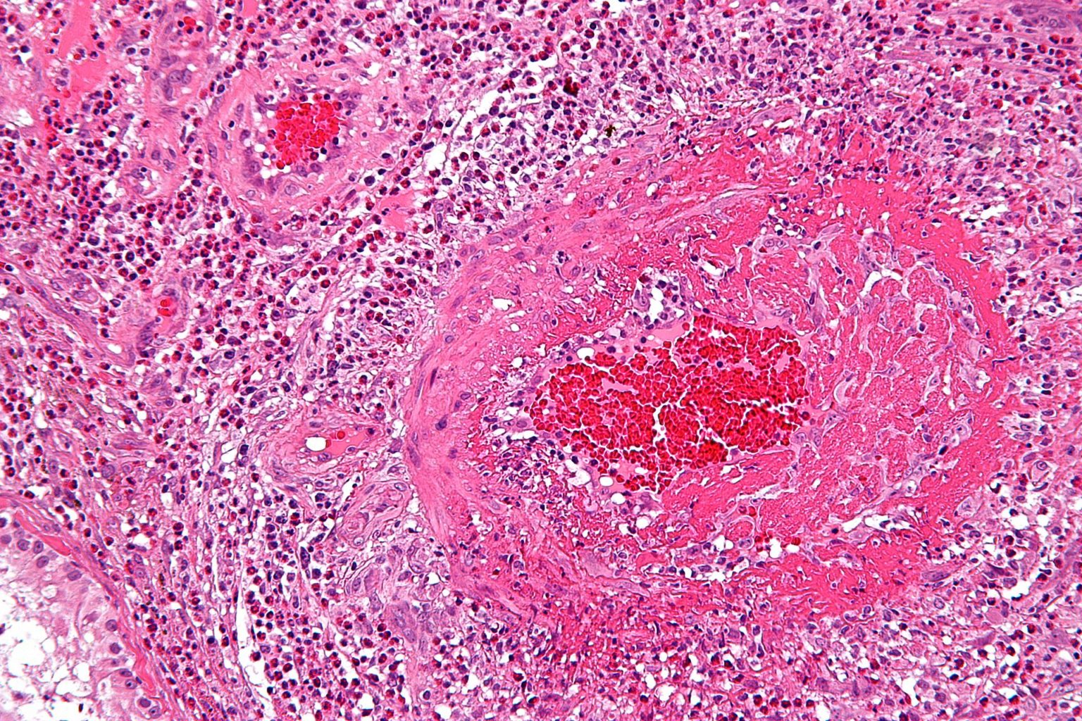 Necrosis Pathology Study Guide – Pathosomes