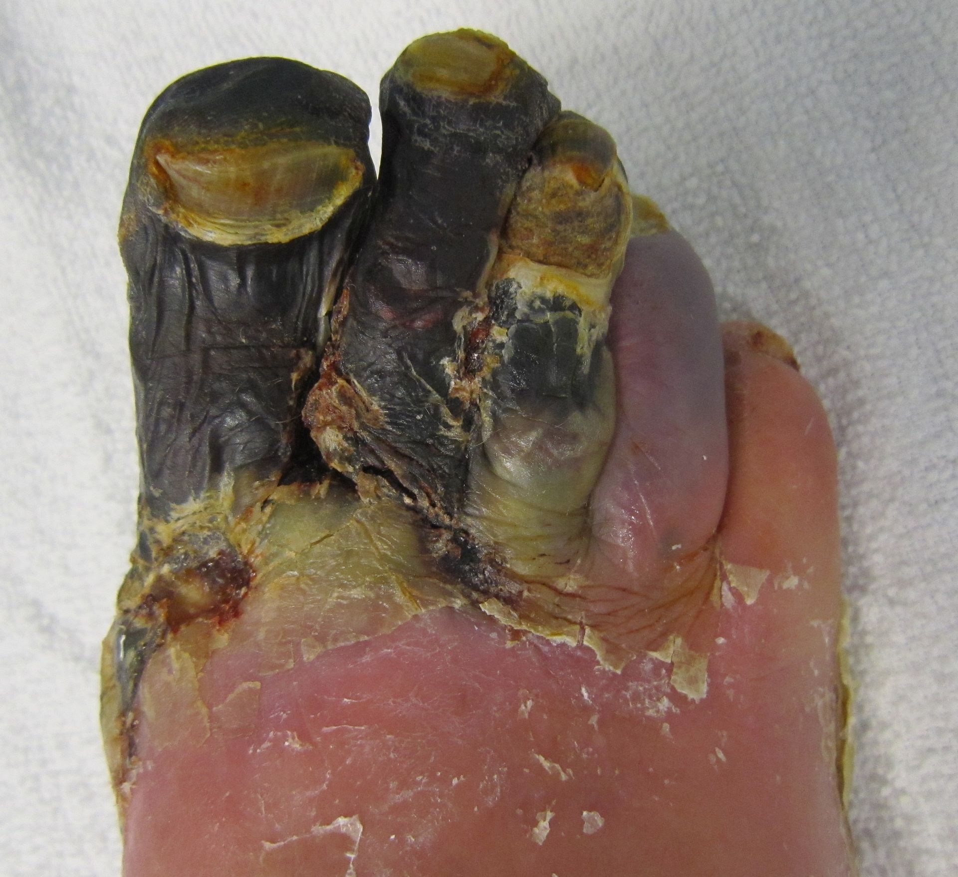 Necrosis Pathology Study Guide – Pathosomes