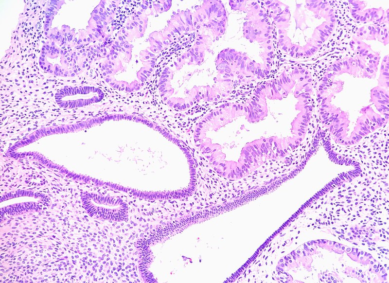 Endometrial Intraepithelial Neoplasia (EIN) – Pathosomes